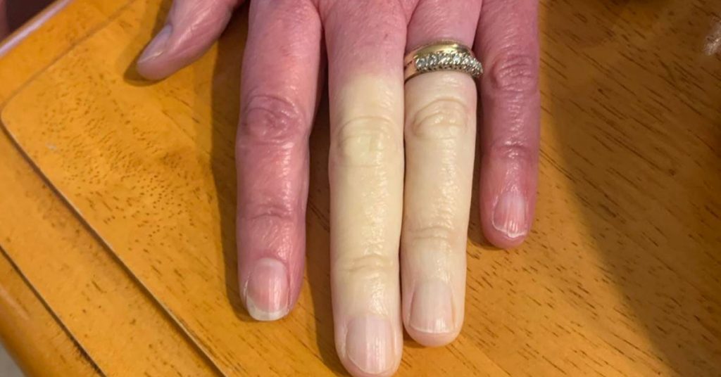 Connaissez-vous la maladie qui rend les doigts blancs